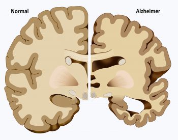 La enfermedad de Alzheimer podría revertirse | Periodistas en Español